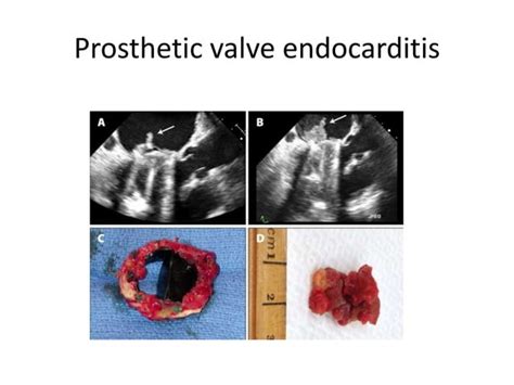Echo In Prosthetic Valve Evaluation Pptx