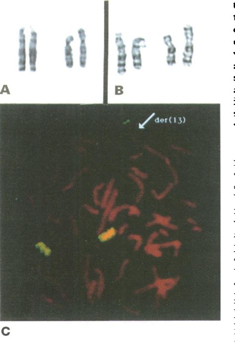 Figure 1 From A Case Of Duplication Of 13q32 Qter And Deletion Of 18p 1 32 Pter With Mild