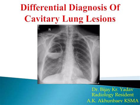 What Is Cavitation On Chest X Ray