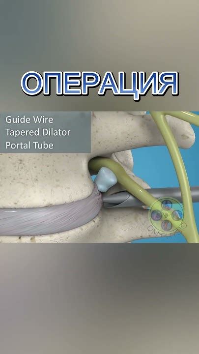 ДИСКОВА ХЕРНИЯ ОПЕРАЦИЯ Youtube