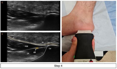 How To Perform Baxters Nerve Blockage Easily By Ultrasound In Chronic
