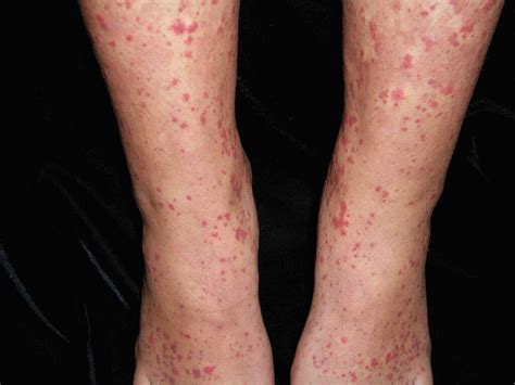 Iga Vaskulitis Im Erwachsenenalter Vielfältige Symptome Und Komplikationen Medical Tribune