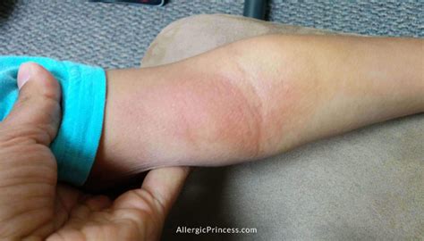 Our Food Allergy Oit Success Story Allergic Princess
