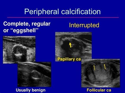 Pin On Thyroide