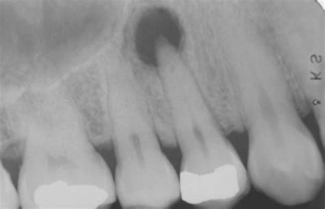 Oral Path 12 Pulpal And Periapical Diseases Pics Flashcards Quizlet