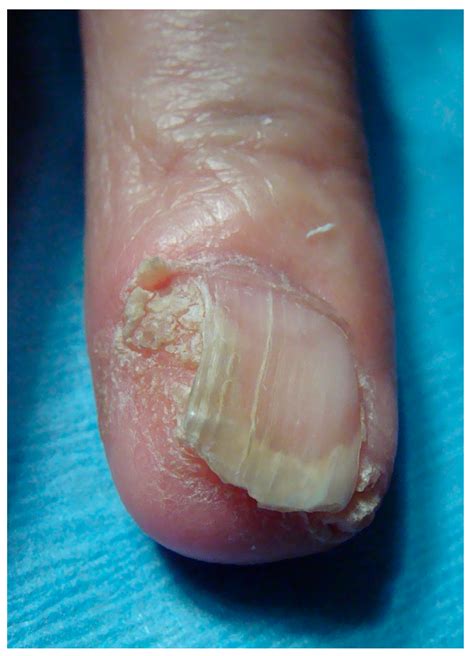 Diagnosis And Management Of Malignant Epithelial Nail Unit Tumors