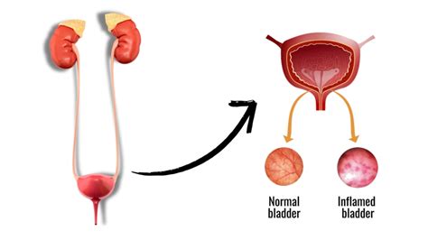 Bladder Inflammation Comprehensive Guide With Anf Therapy®️