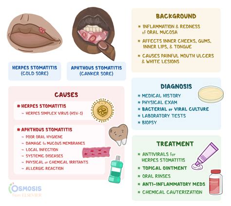 Aphthous Stomatitis Treatment