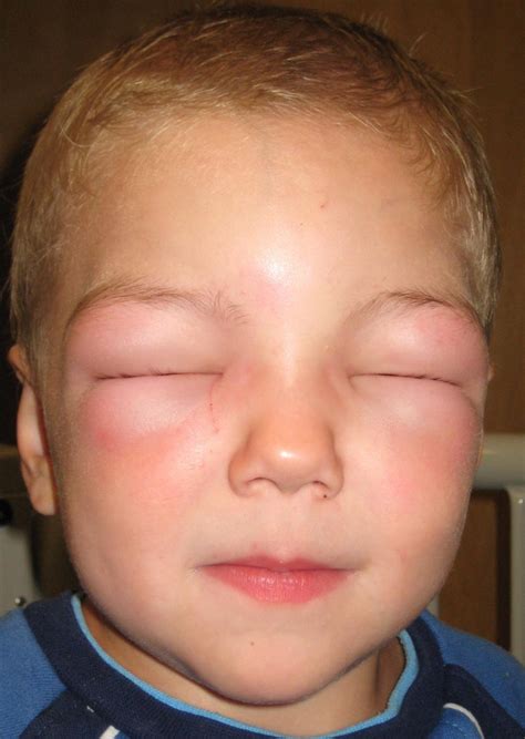 Allergic Reaction Swollen Lips And Eyes At Thomas Allsup Blog