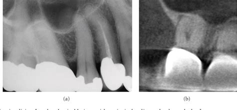 Figure 1 From Use Of Cone Beam Computed Tomography In Endodontics Semantic Scholar
