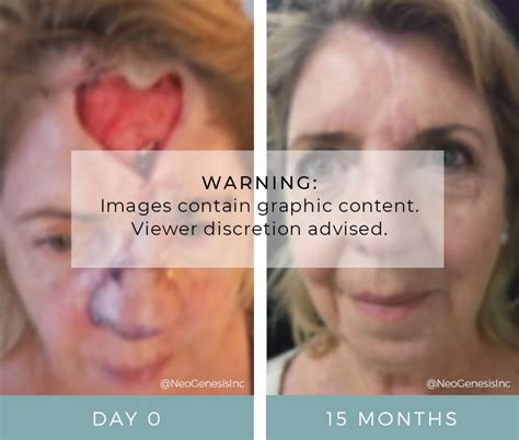 Invasive Ductile Carcinoma Radiation Burns Before After Photos