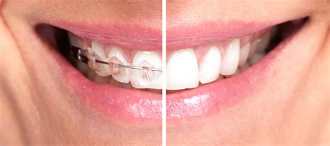 Invisalign Clear Braces