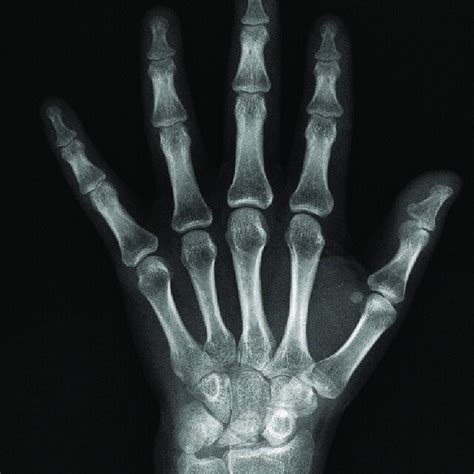 Kienbocks Disease Stage 3b The Collapse Of Lunate Fixed Scaphoid Download Scientific Diagram