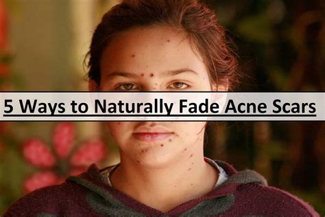 5 Ways To Naturally Fade Acne Scars By News Web Zone