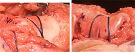 Thick Shell Sulcus Deepening Trochleoplasty For Recurrent Patellar