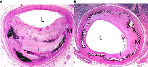 Hande Stain Of Tibial Arteries From Patient With Intimal A And Medial Download Scientific