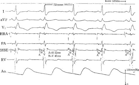 Figure From Sinus And Atrioventricular Nodal Re Entrant Tachycardia Semantic Scholar