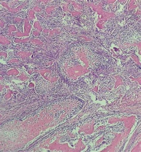 Tumor óseo Multilobular Grado Ii Reporte De Caso Clinoncovet