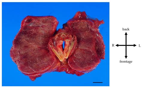 Gross Findings Of Goiter Weight Of The Goiter Was 675 G Size Of The