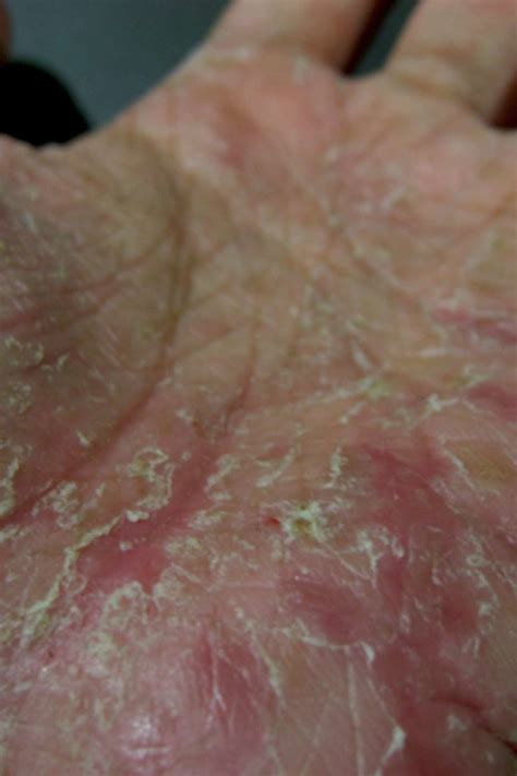 What Does A Rash On Your Hands Mean