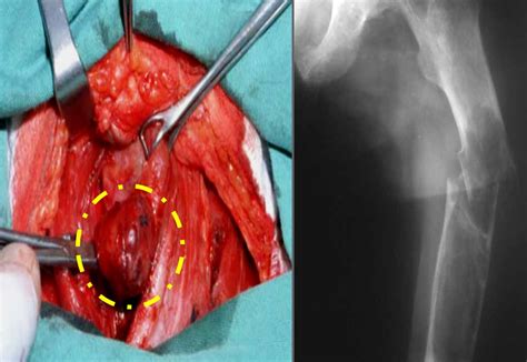 Pathological Bone Fracture Oncosurgery