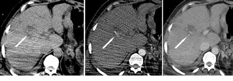 Figure 1 From Multiphase Multidetector Ct In The Diagnosis Of