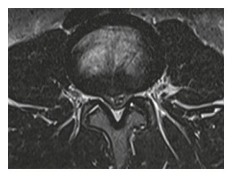 Preoperative Sagittal T2 Weighted Mri From Sagittal View Showed Disc