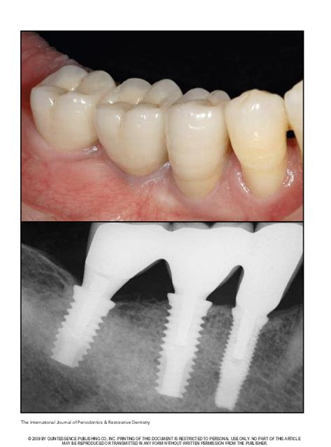 Pdf Evaluation Of Hard Tissue Response Around Wider Platform Switched Implants