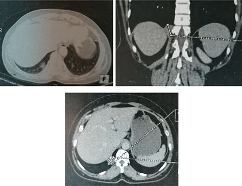 Ct Chest Scan A Solitary Nodule Of Posterobasal Segment Of The Right