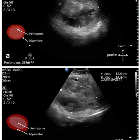 E chographie cardiaque en coupe apicale quatre cavités sonde