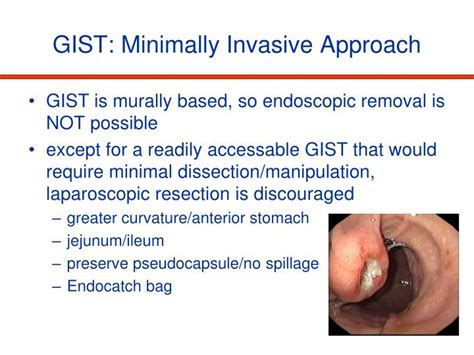 Ppt The Surgeons Role In The Management Of Gastrointestinal Stromal Tumors Gist Powerpoint