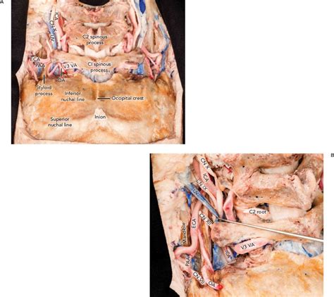 Extracranial Intracranial Bypass Neupsy Key