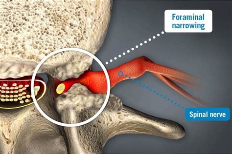 Foraminal Narrowing D Render Walkley Chiropractic Group