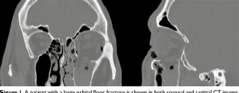 Figure 1 From Surgical Repair Of Orbital Blow Out Fractures Outcomes
