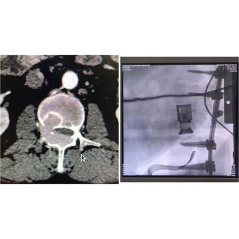 Felipe Sebastián Criollo Palacios On Linkedin Tumor De Células Gigantes De Vértebra Lumbar Primera