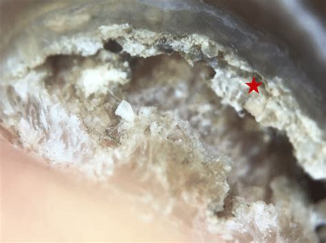 Total Dystrophic Onychomycosis