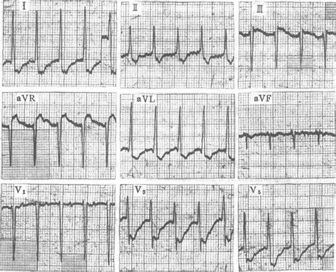 一 阵发性心室上性心动过速 临床心电图学及 医学