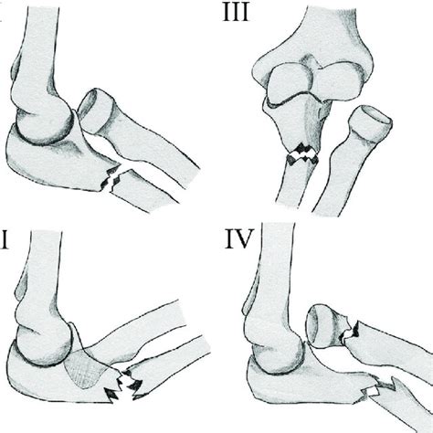 Preoperative Lateral Radiograph Of The Right Elbow Demonstrating A Type