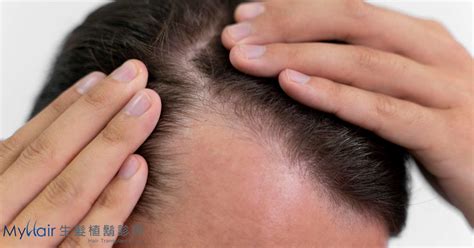 年紀輕輕就被叫「阿北」？雄性禿治療要趁早側錄 Myhair生髮植鬍診所 植髮診所首選推薦