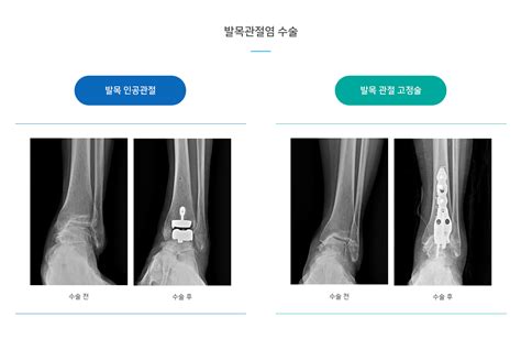 웰본정형외과 발목관절염 수술