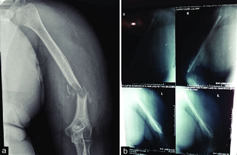 A X Ray Showing Pathological Humeral Fracture Of The Distal Third Of Download Scientific