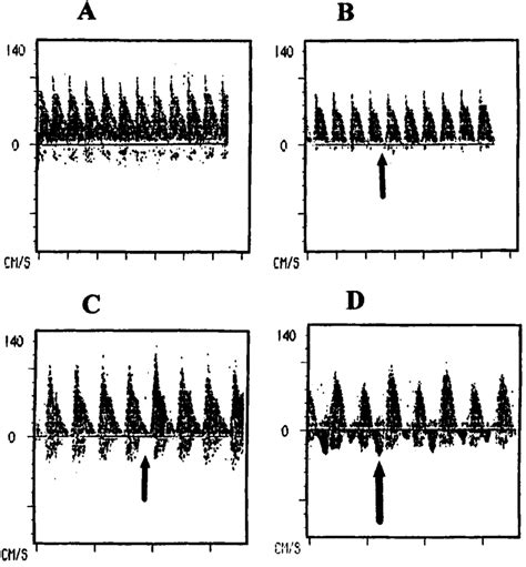 Tcd Waveforms Recorded Before A And After B Residual Aortic Valve Download Scientific