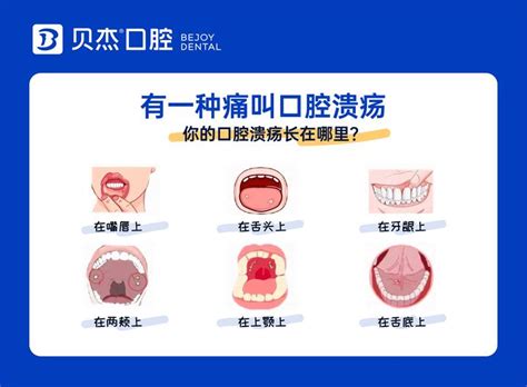 合肥贝杰口腔医院 口腔溃疡的痛😭😩谁懂啊？口腔溃疡应该怎么办？ 知乎