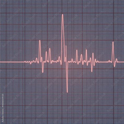 Electrocardiogram Show St Elevation Myocardial Infarction Stemi