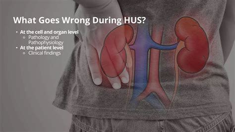 Hemolytic Uremic Syndrome Hus Chris Edits 73123pptx