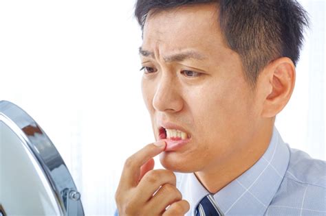 何度もできやすい口内炎。タイプでわかる口内炎の原因と治療方法 歯科コラム 周南市久米の歯医者「ひだまり歯科医院」一日100名以上が来院