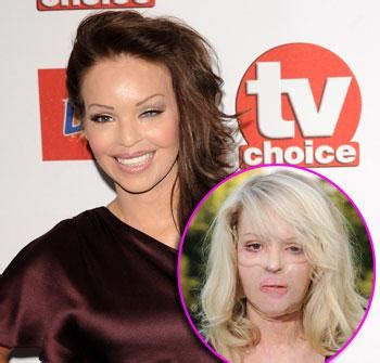 Former Model Acid Attack Victim Katie Piper Reveals Her Miraculous Recovery