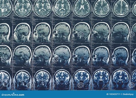 Scansione Del Cervello Rmi O Raggi X O Immagine A Risonanza Magnetica