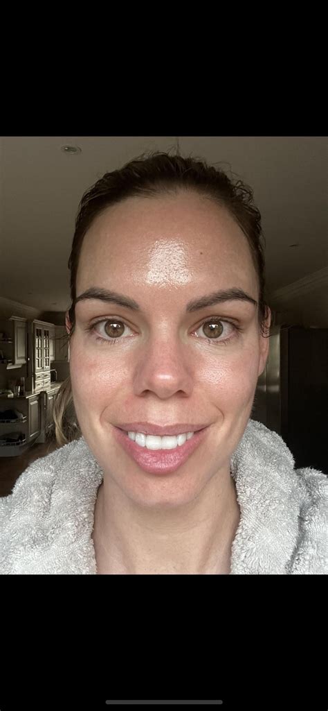 Before And After 7 Months Rtretinoin