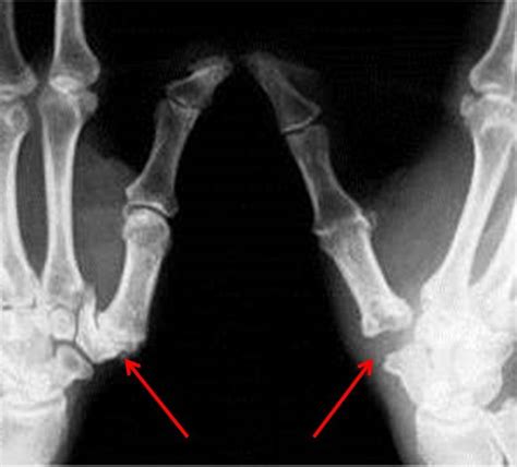 Basal Joint Hand Surgery At Belinda Baker Blog